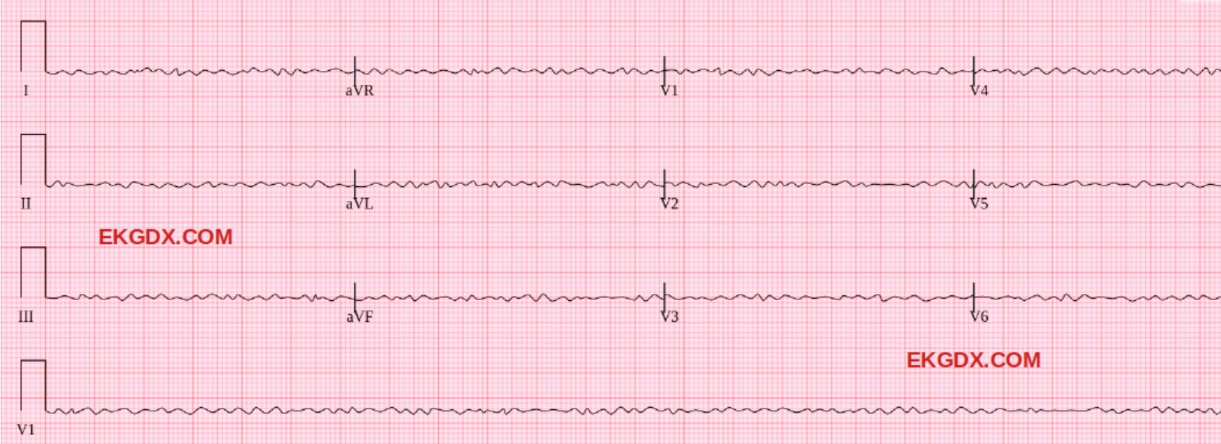 Vf Ecg Multiple The Ventricular Fibrillation (VF) ECG/EKG